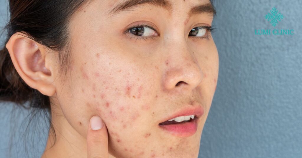 Facial KL | Acne Types: Pictures, Treatment